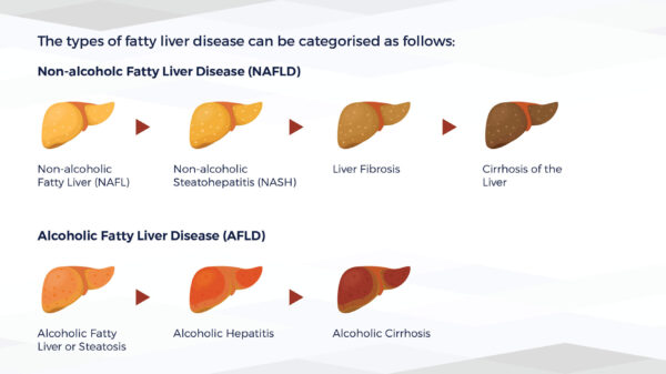 Fatty Liver Disease: Causes, Symptoms, and Treatment Options - GHHS ...