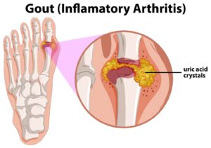 Gout Guide: Causes, Symptoms, Treatments & Prevention Tips - GHHS Healthcare