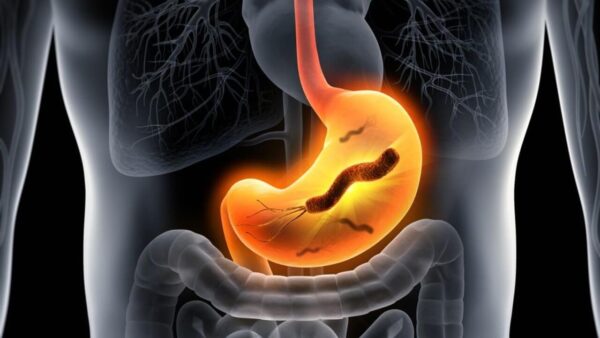 What is H. Pylori Infection and How It Affects Your Stomach Health ...